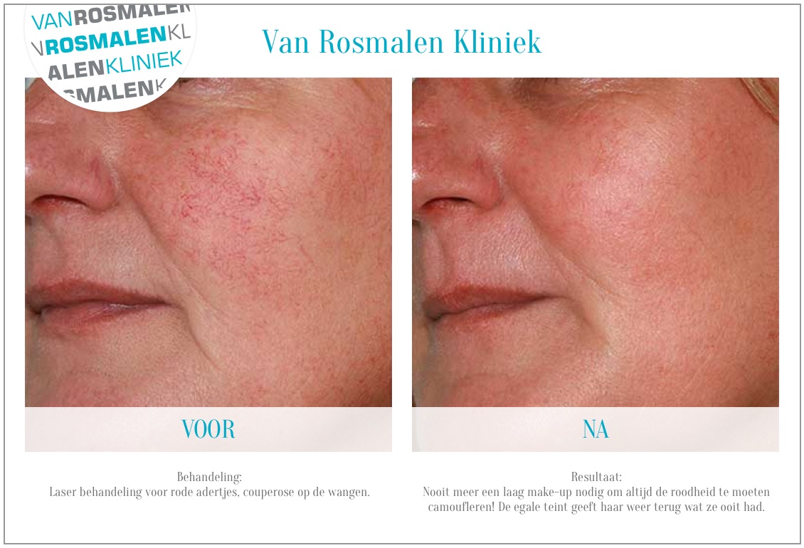 Ontdek onze Couperose Behandeling | Van Rosmalen Kliniek