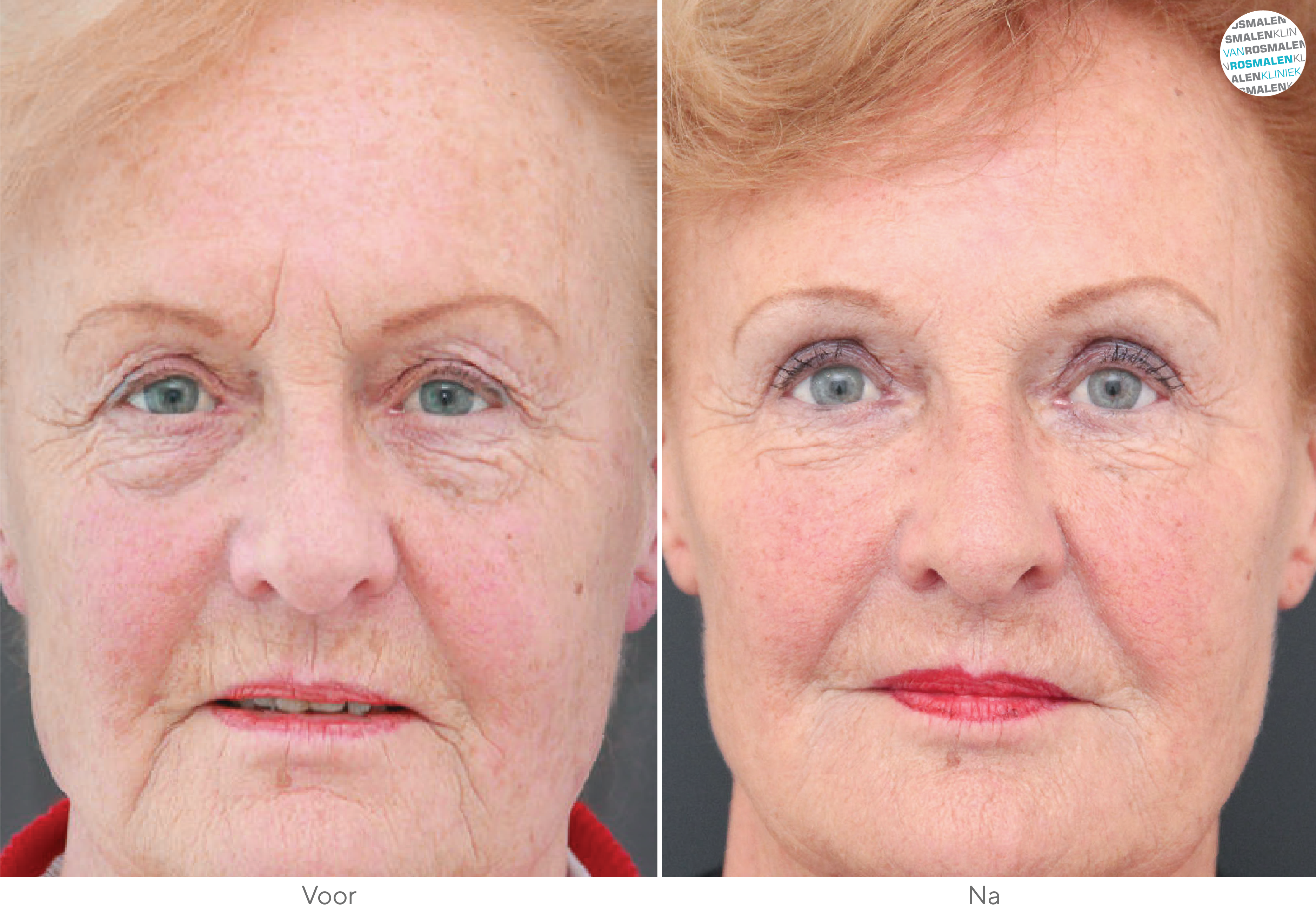 Voor en na foto's van diverse behandelingen | Van Rosmalen Kliniek