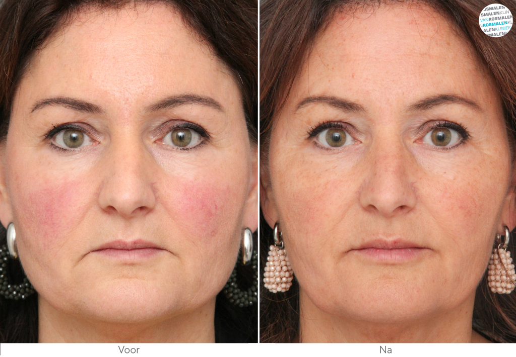 Mondhoeken botox behandeling voor- en na foto | Van Rosmalen Kliniek