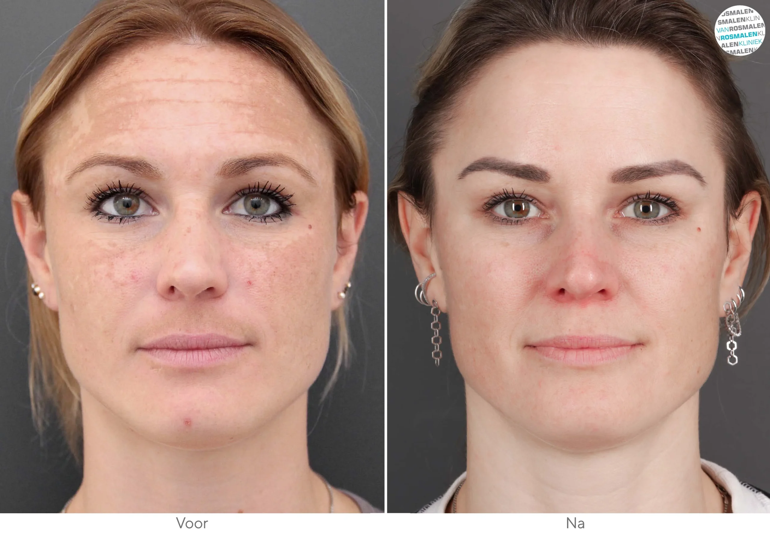 Voor en na foto's van diverse behandelingen | Van Rosmalen Kliniek